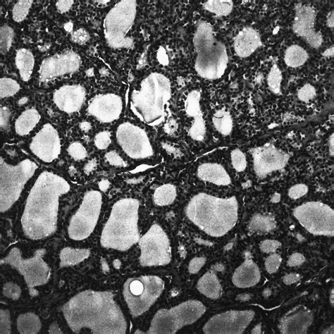 Histology Of The Resected Thyroid Gland Showing Diffuse Hyperplasia And