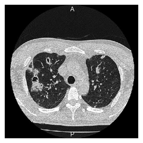 A Chest X Ray Showing Multiple Bilateral Nodular Densities B Ct Of