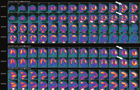 82 Rb Pet Perfusion Images Show A Fixed Perfusion Defect On Both Stress