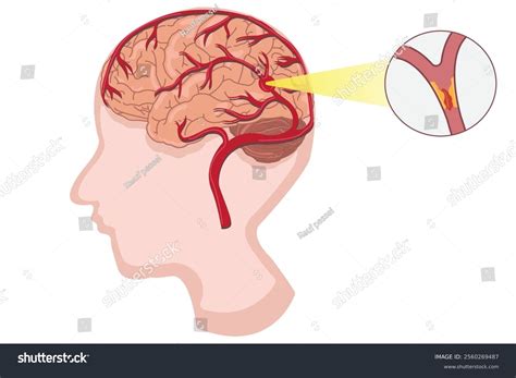 Illustration Ischemic Hemorrhagic Stroke Showing Blocked Stock Vector Royalty Free 2560269487
