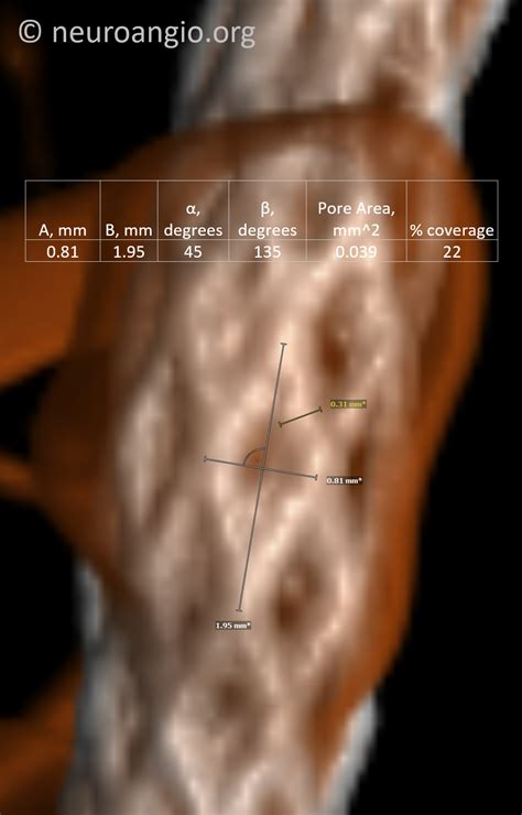 Vertebral Fusiform Aneurysm Pipeline Shield Embolization — Analysis Of Metal Coverage Density