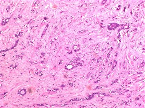 Atlas Of Breast Cancer Early Detection