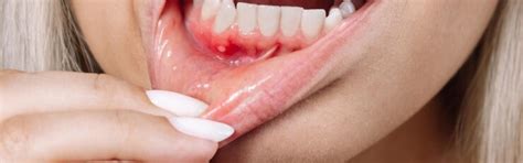 Bump On Gums 7 Signs Causes And Dental Solutions