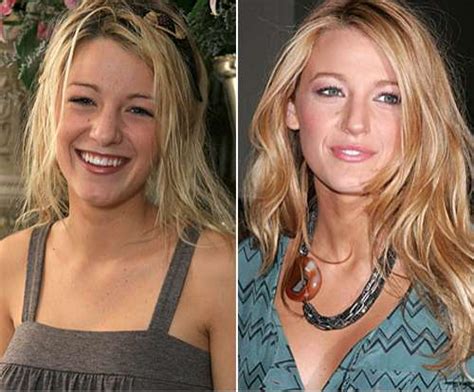 Blake Lively Nose Job Before And After Deviated Septum Information And Advice