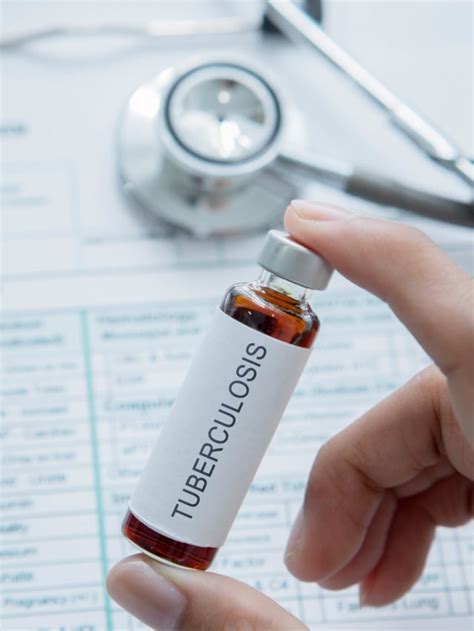 Tuberculosis Second Most Deadly Infectious Disease Claims Over 3 Lakh Lives In India