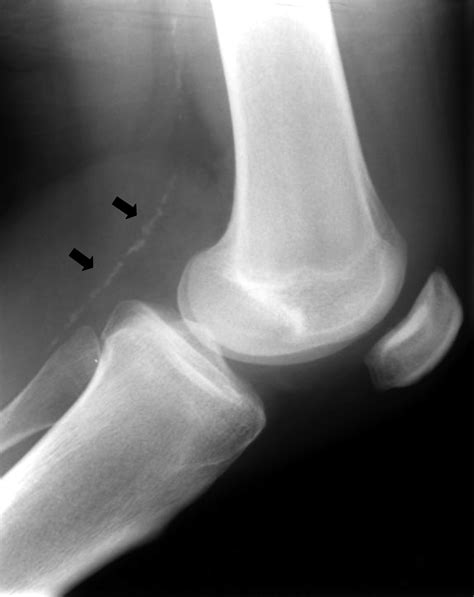 Intermittent Claudication In A 28 Year Old Man With Pseudoxanthoma
