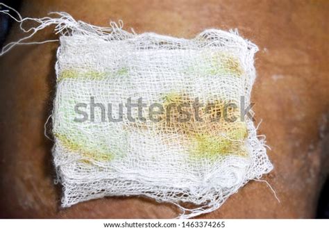 5 Clostridium Difficile Infection Man Royalty Free Photos And Stock Images Shutterstock