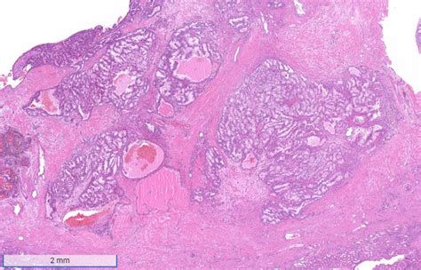 Week 754 Case 1 Johns Hopkins Surgical Pathology Unknown Conference