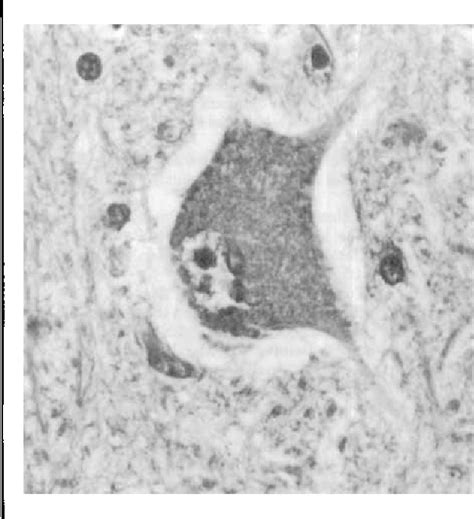 Figure 1 From Gammopathy With Proximal Motor Axonopathy Simulating Motor Neuron Disease