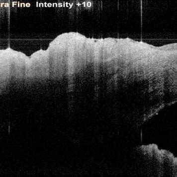 AS OCT Showing Thickened And Hyperreflective Epithelium With Abrupt Download Scientific Diagram