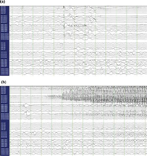 Intracranial Eeg Of Subject 1 A Although Scalp Eeg Suggested The Download Scientific Diagram