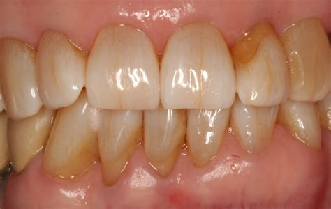 Dental Splints For Loose Teeth At Will Hannah Blog