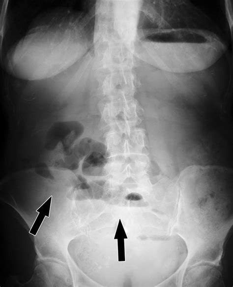 Accuracy Of Abdominal Radiography In Acute Small Bowel Obstruction