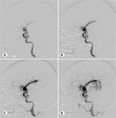 Subsequent Cerebral DSA Images In Lateral Projection Demonstrating Download Scientific Diagram
