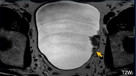 The Radiology Assistant Bladder Cancer Vi Rads