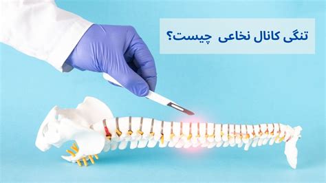 تنگی کانال نخاعی چیست و 20 علائم آن