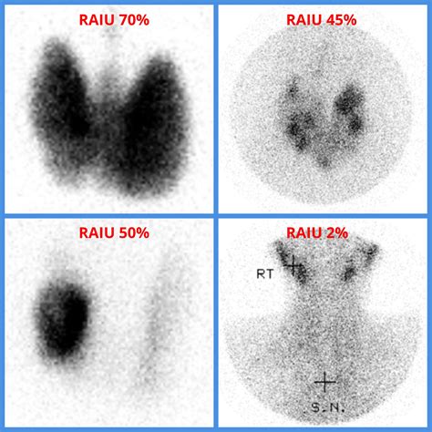 Radioactive Iodine Scan