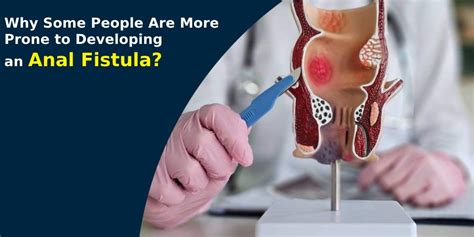 Why Some People Are More Prone To Developing An Anal Fistula