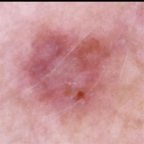 Skin Cancer Ham10000 Hair Removal Kaggle