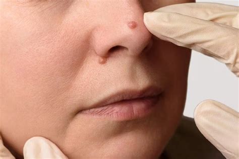 Verrugas En La Cara Por Qué Salen Y Cómo Quitarlas Clínica Cermar