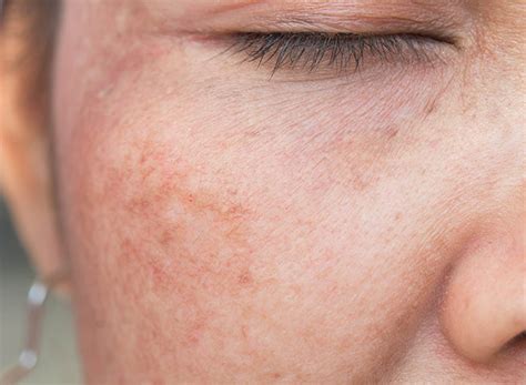 Хиперпигментация и петна по кожата премахване и превенция