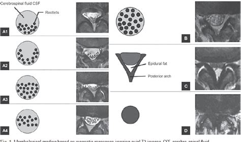 Lumbar Grade 2 At Priscilla Scott Blog