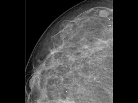 Fat Necrosis Breast Mammogram