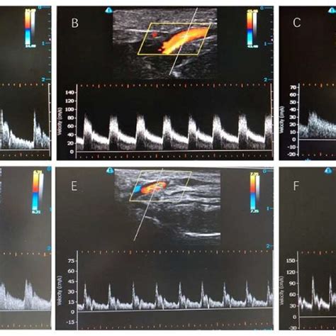 Color Doppler Spectrogram Of The Sta Blood Flow Between Low And High