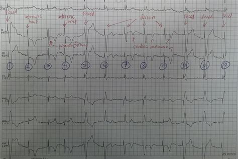ECG Rhythms Multiple Beats In One Strip T Wave Memory