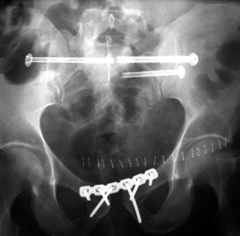 Ct Guided Iliosacral Screw Placement Technique And Clinical Experience