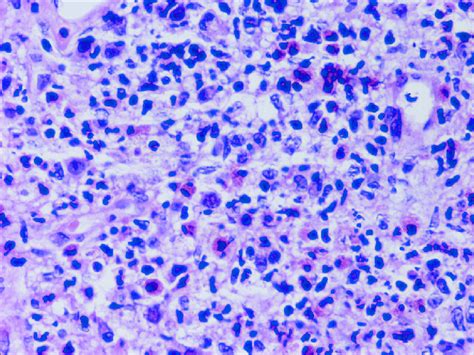 Dermal Polymorphous Infiltrate With Abundance Of Eosinophils H And E Dermal Polymorphous Infiltrate With Abundance Of Eosinophils H And E