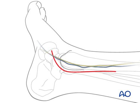 Posteromedial Approach To The Distal Tibia