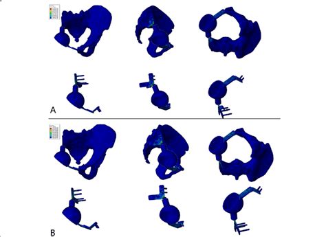 Stress Distribution Of The Pelvis Reconstructed Using A Prosthesis With