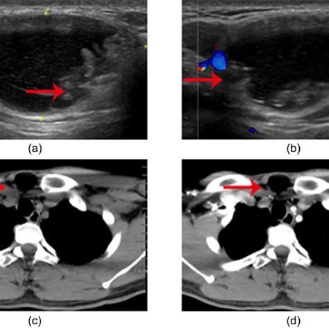 Pdf Mature Cystic Teratoma Of The Suprasternal Fossa In An Adult