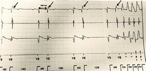 Device Interrogation Showing Uniform Pvc Vf Triggers Download