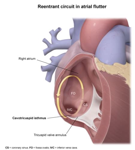 Atrial Flutter Flashcards Quizlet