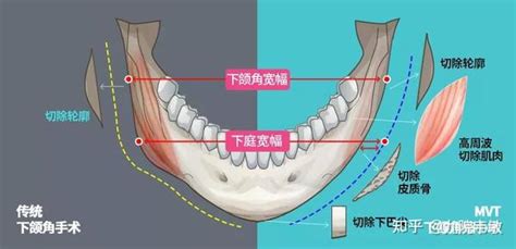 九院韦敏说做下颌角手术前，你可能需要了解这3个准备 知乎