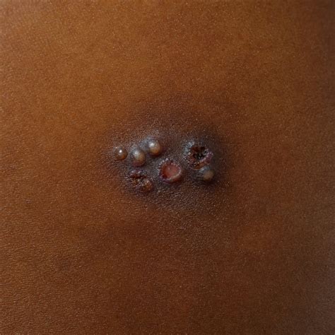Black Papule On Labia Majora