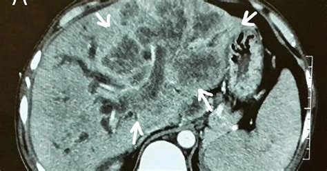 Ercp And Egd A Very Large Intrahepatic Cholangiocarcinoma