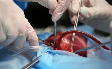 Canada Turns Euthanasia Into Organ Trafficking — Life Site Eadaily