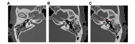 High Resolution Computed Tomography Scan Of The Temporal Bone With Bone Download Scientific