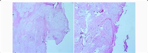 Dystrophic Features Myxoid And Chondroid Matrix Of The Well Developed