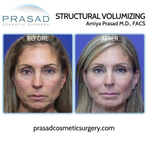 What Causes “pillow Face” From Fillers And How To Avoid It