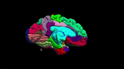 Polymicrogyria Youtube