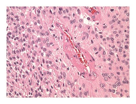 Hande Stain Demonstrating A Perivascular Pseudorosette With Blunted End