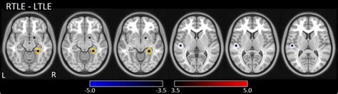 Latency Group Difference Map Rtle Patients Minus Ltle Patients
