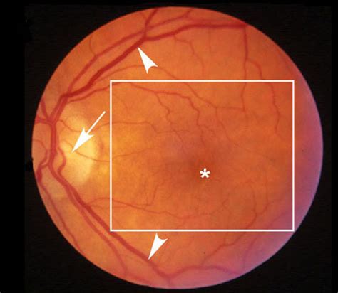 Normal Macula