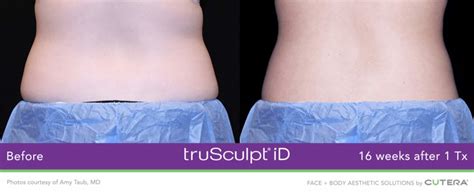 Trusculpt® Id Build Your Dream Body Dr Scott Allison