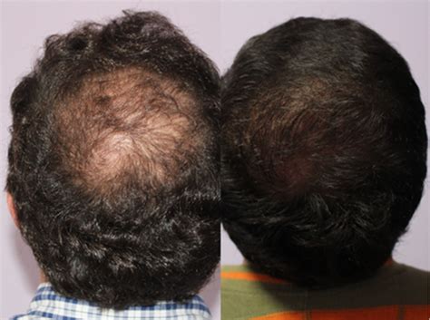 Hairline International