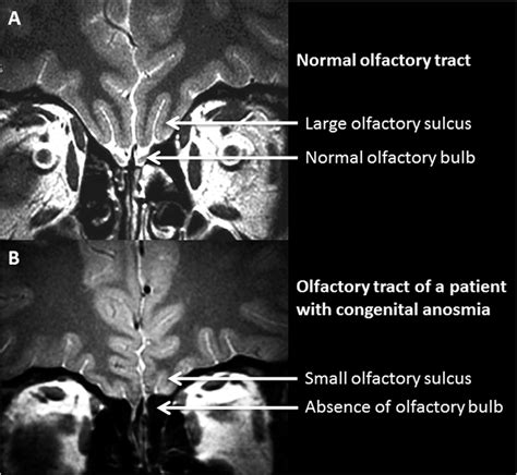Mri Coronal View Of The Olfactory Tract Of A Healthy Subject A And Of